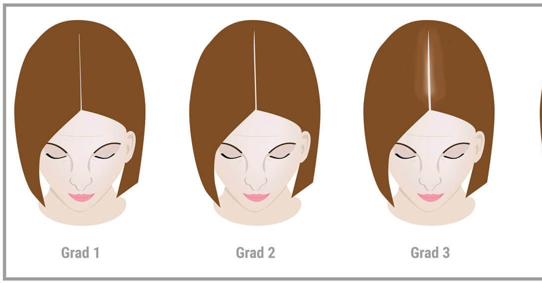 Plantur 39 | Symptoms of hair loss in women during the menopause